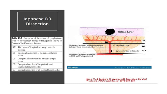 Complete Mesocolic Excision Cme Vs D2 Pptx