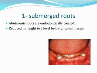 Complete overdenture(3) | PDF