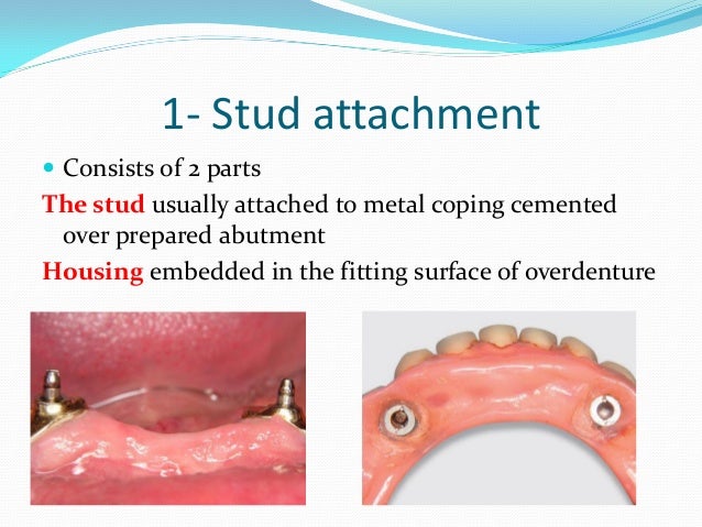 Complete overdenture(3)