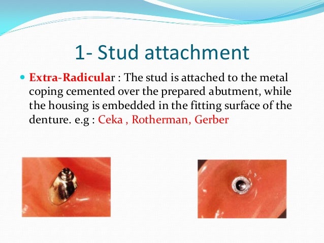 Complete overdenture(3)