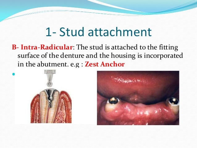 Complete overdenture(3)