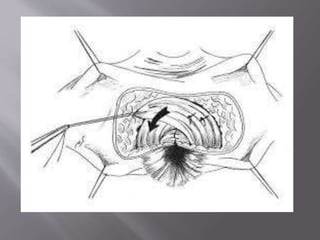 Complete perineal tear | PPTX