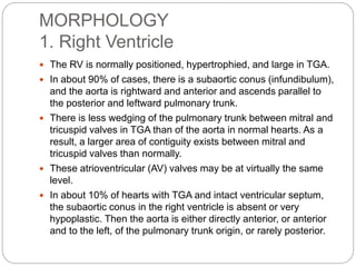 Complete transposition of great arteries | PPTX