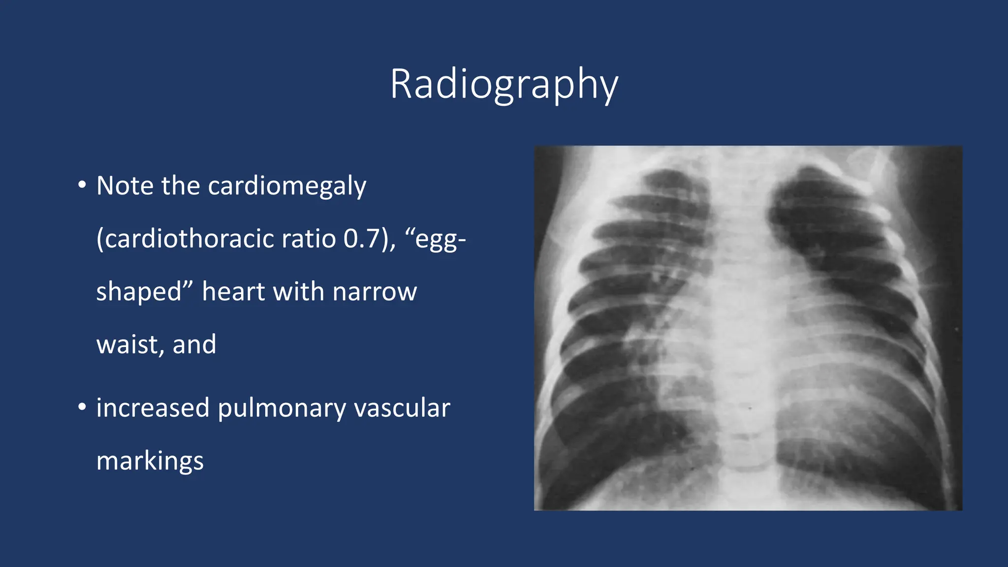 Complete transposition of the great arteries (D-TGA.pptx