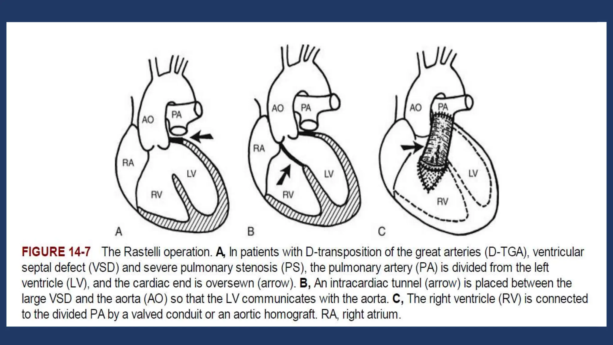 Complete transposition of the great arteries (D-TGA.pptx