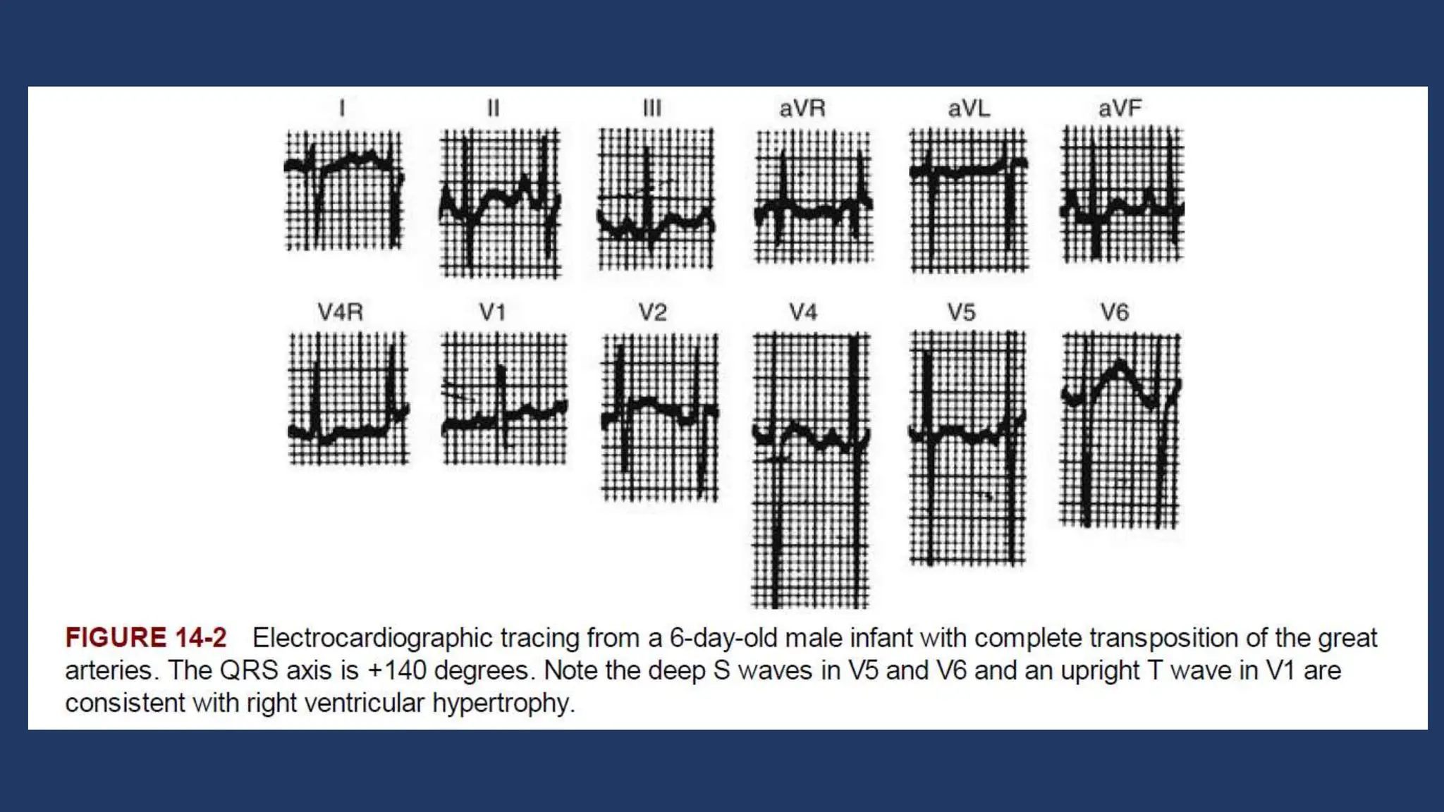 Complete transposition of the great arteries (D-TGA.pptx