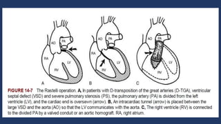 Complete transposition of the great arteries (D-TGA.pptx