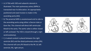 Complete transposition of the great arteries (D-TGA.pptx