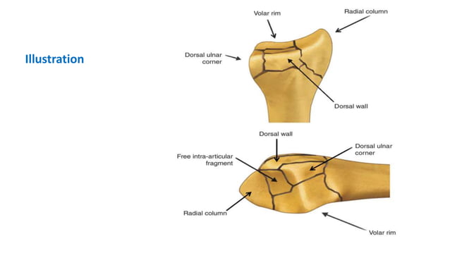Complex Distal Radius Fracture #dr_azanki | PPT