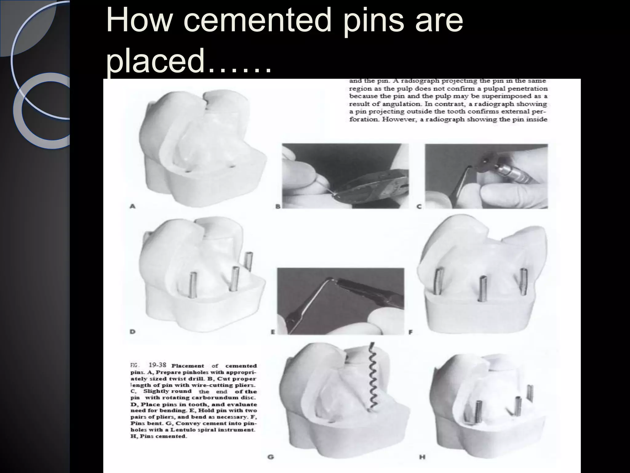Complex amalgam restorations | PPTX