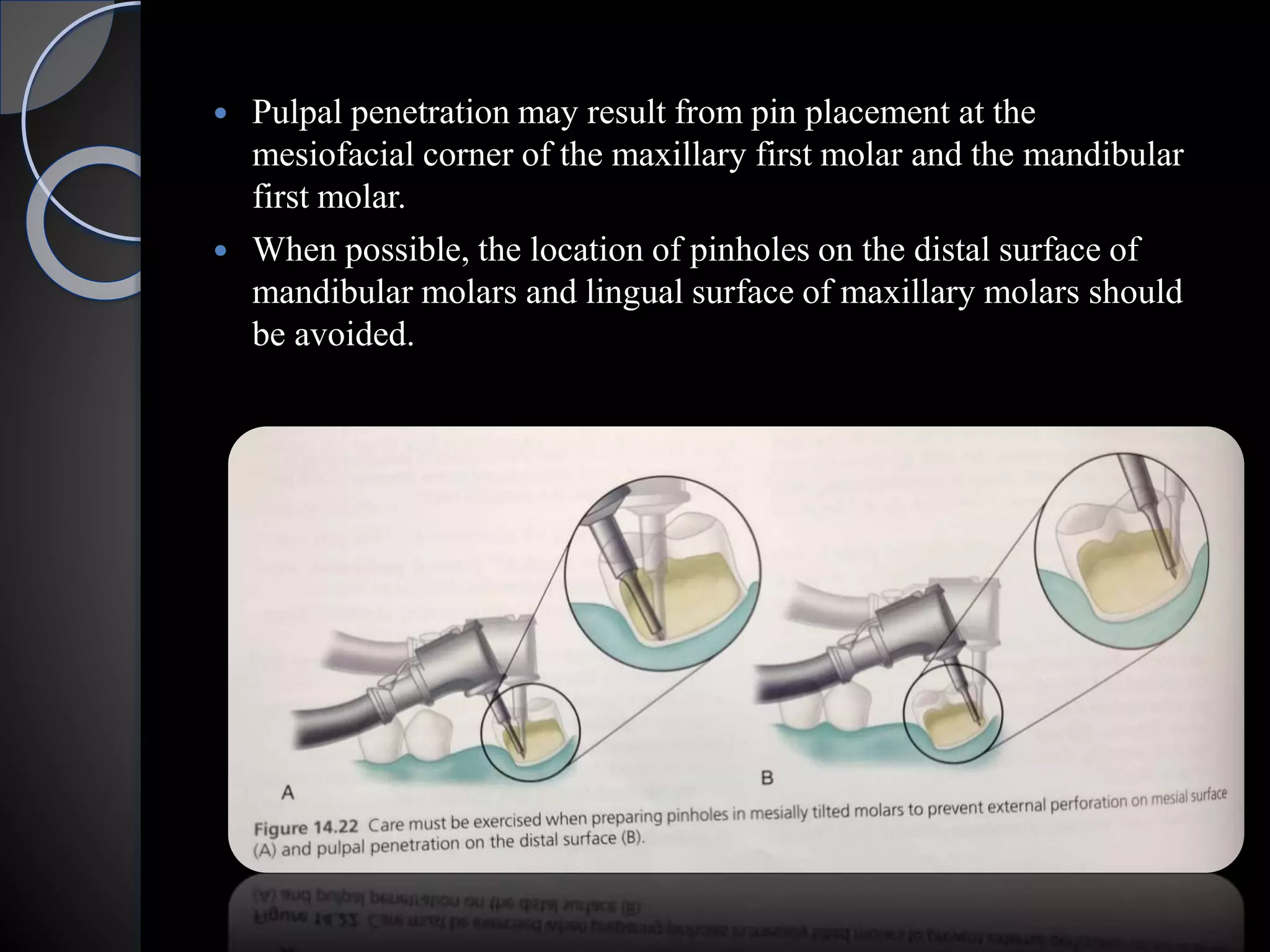 Complex amalgam restorations | PPTX