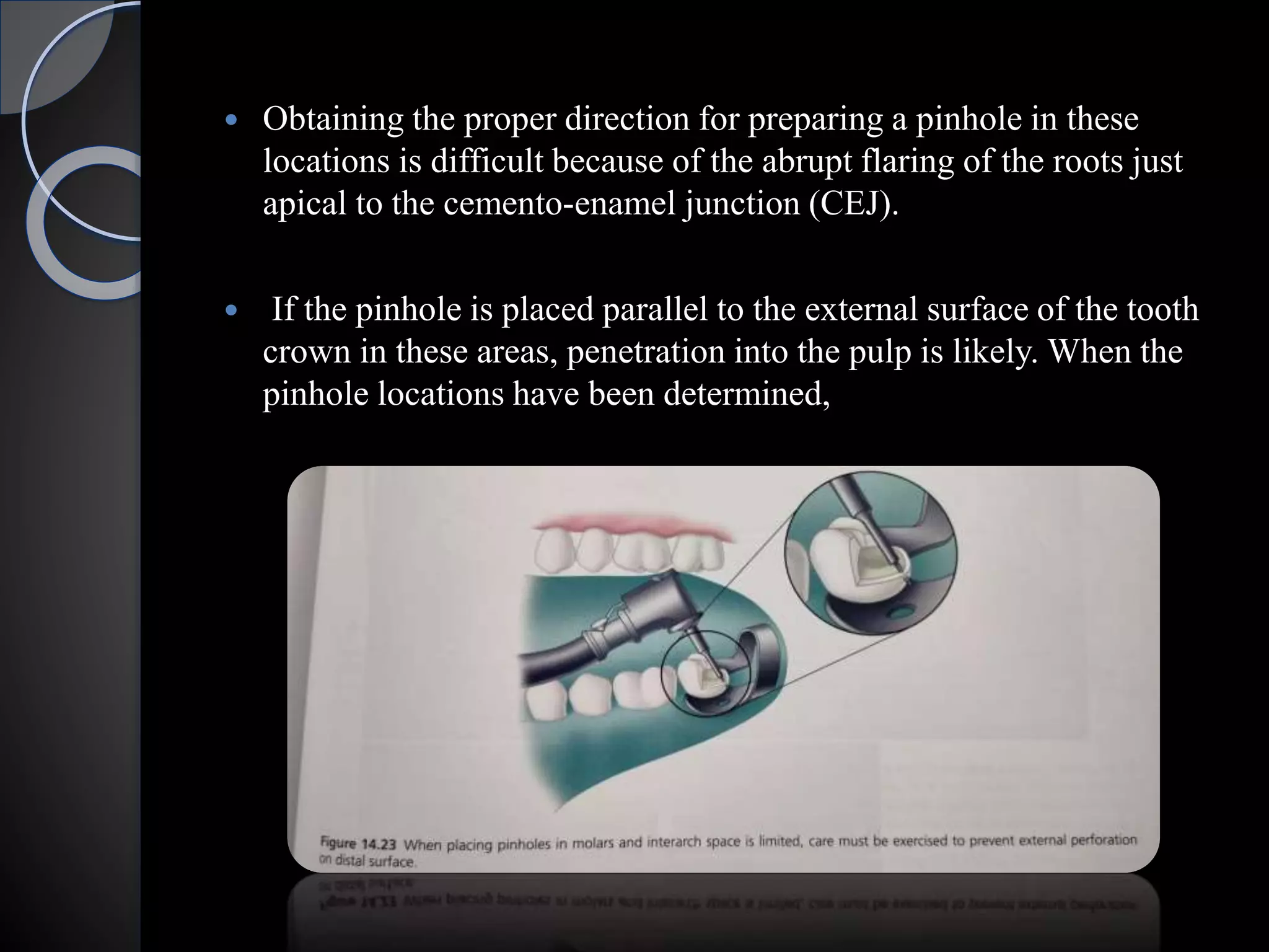 Complex amalgam restorations | PPTX