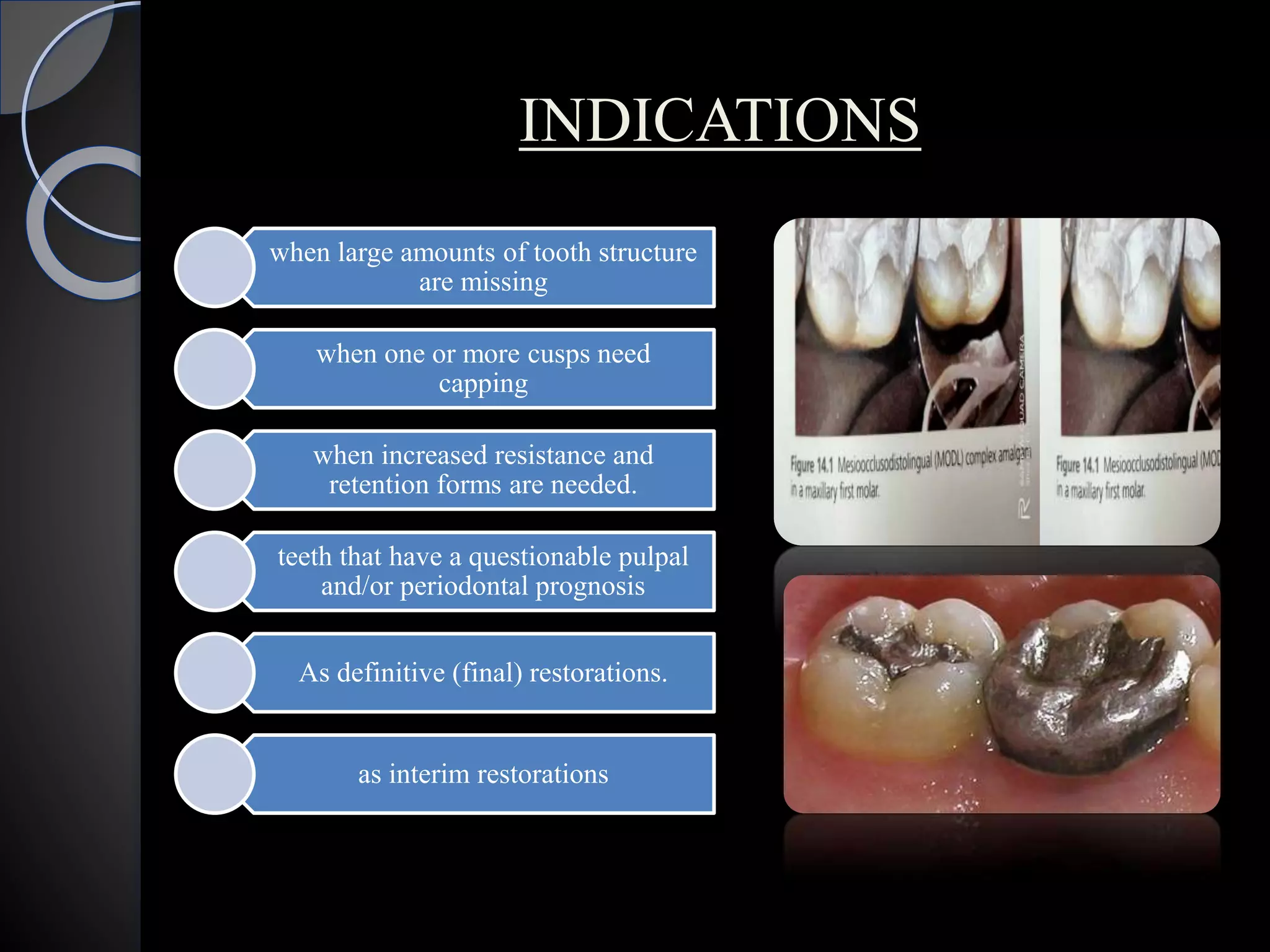 Complex amalgam restorations | PPTX