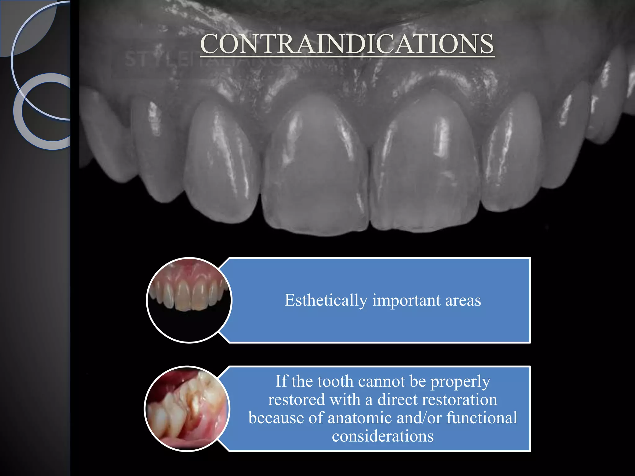Complex amalgam restorations | PPTX