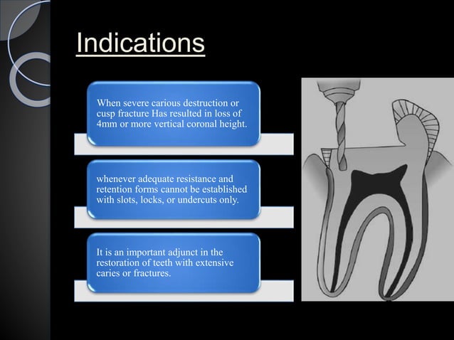 Complex amalgam restorations | PPTX
