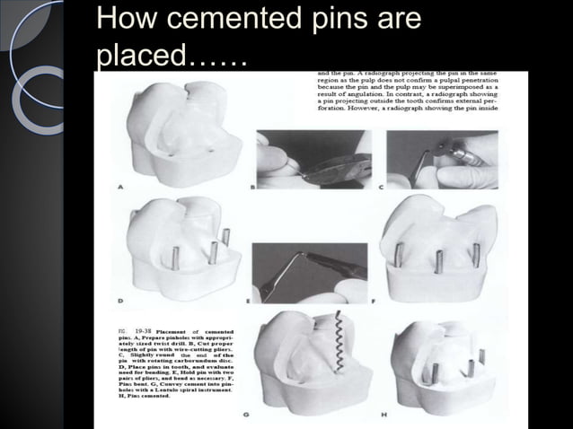 Complex amalgam restorations | PPTX
