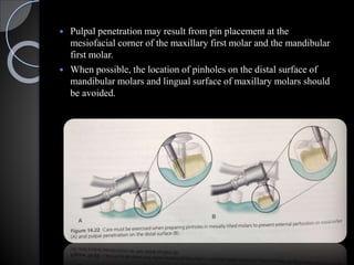 Complex amalgam restorations | PPTX