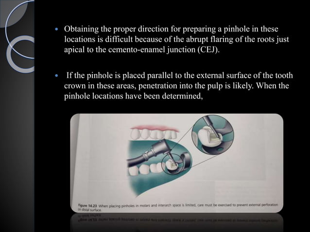 Complex amalgam restorations | PPTX