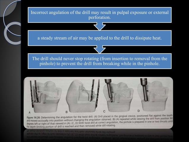 Complex amalgam restorations | PPTX
