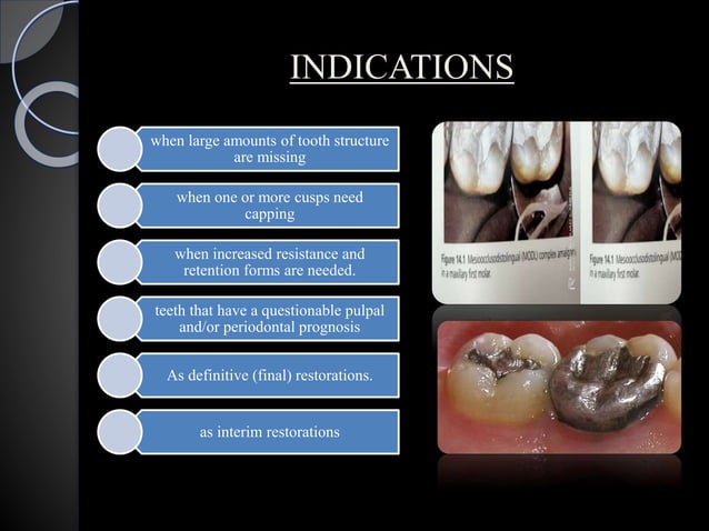 Complex amalgam restorations | PPTX