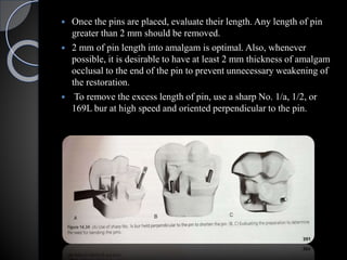 Complex amalgam restorations | PPT