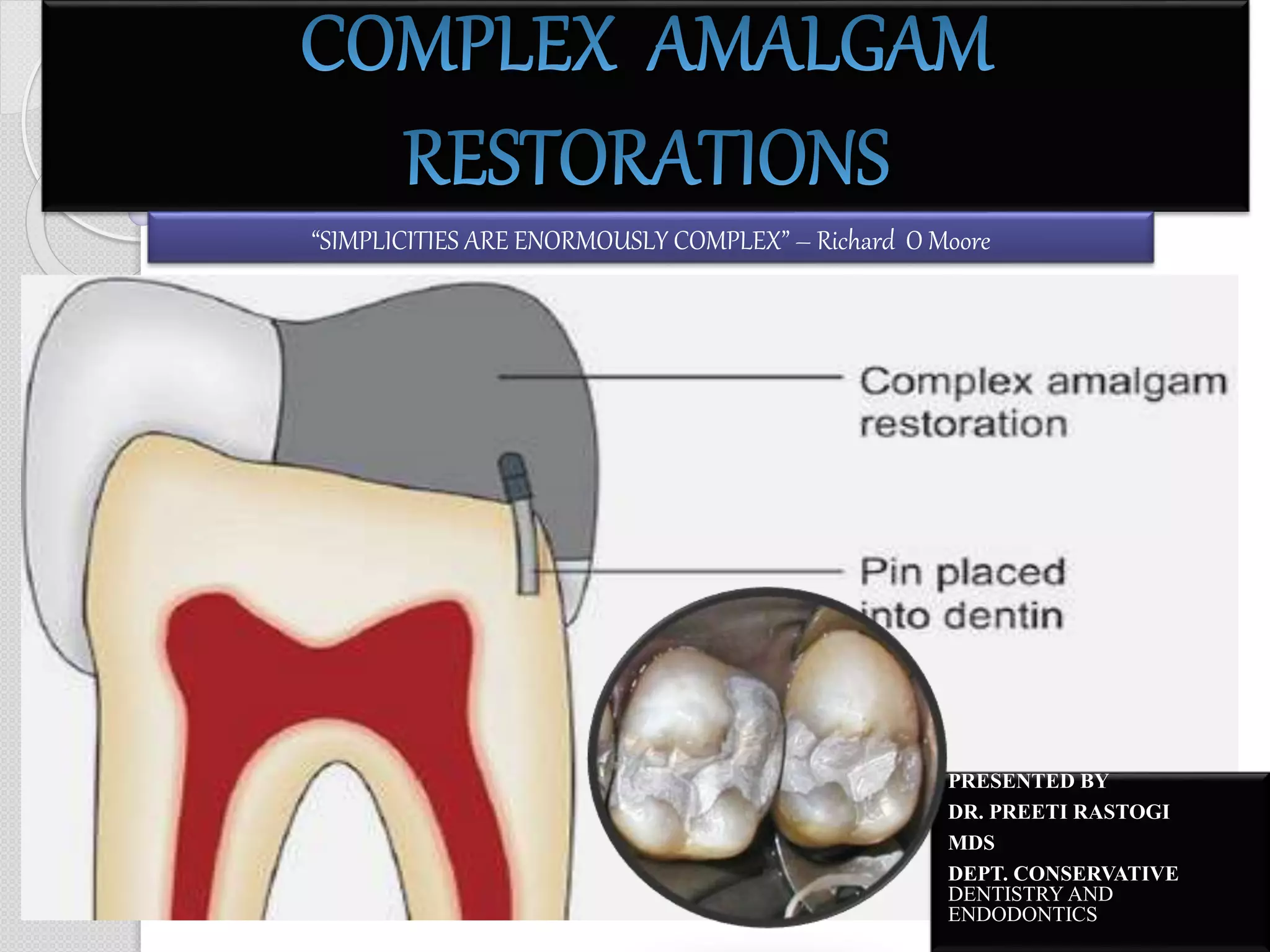 Complex amalgam restoration | PPTX