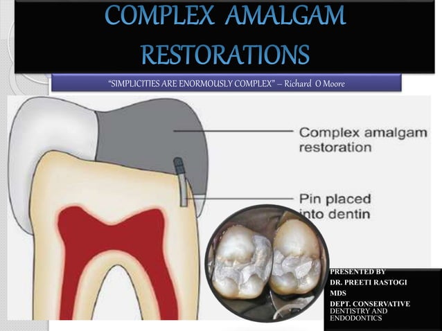 Complex amalgam restoration | PPTX | Dental Health | Diseases and Conditions