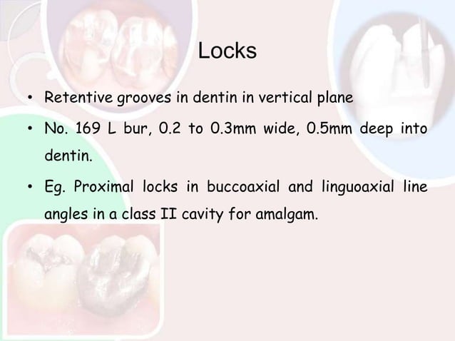 Complex amalgam restoration | PPTX | Dental Health | Diseases and ...