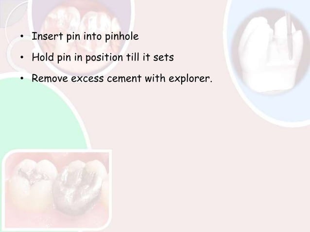 Complex amalgam restoration | PPTX | Dental Health | Diseases and ...