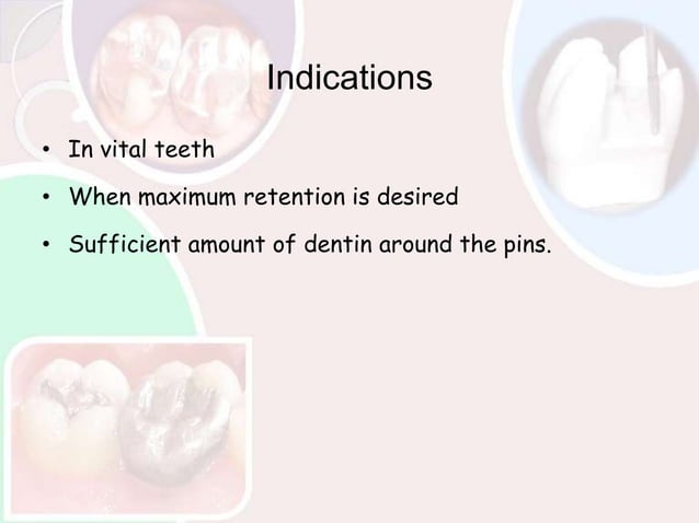 Complex amalgam restoration | PPTX | Dental Health | Diseases and ...
