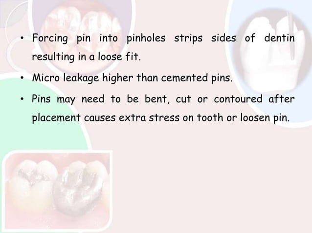 Complex amalgam restoration | PPTX | Dental Health | Diseases and ...