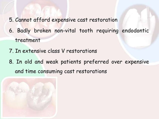 Complex amalgam restoration | PPTX | Dental Health | Diseases and ...