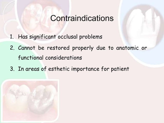 Complex amalgam restoration | PPTX | Dental Health | Diseases and ...