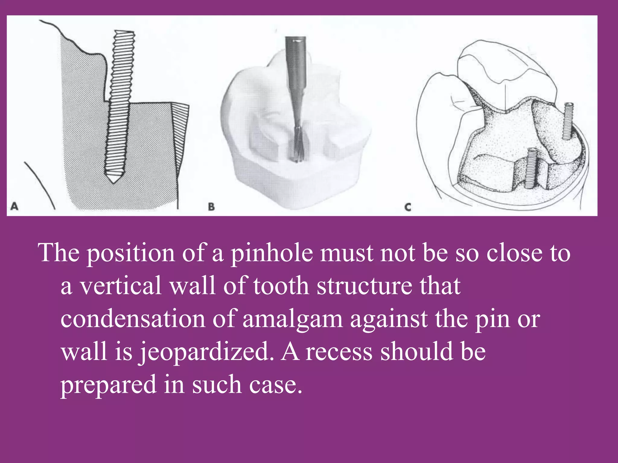 Complex Amalgam Restorations Pptx Dental Health Diseases And Conditions