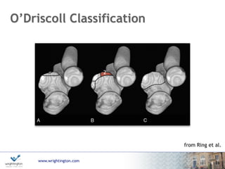 Complex elbow injuries involving radial head | PDF