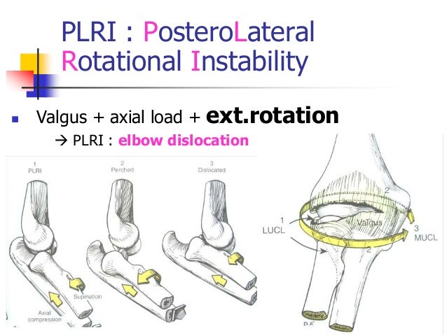 Complex elbow injury 2013