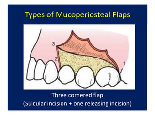 Complex exodontia contemporary chapter 8.pptx