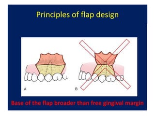 Complex exodontia contemporary chapter 8.pptx