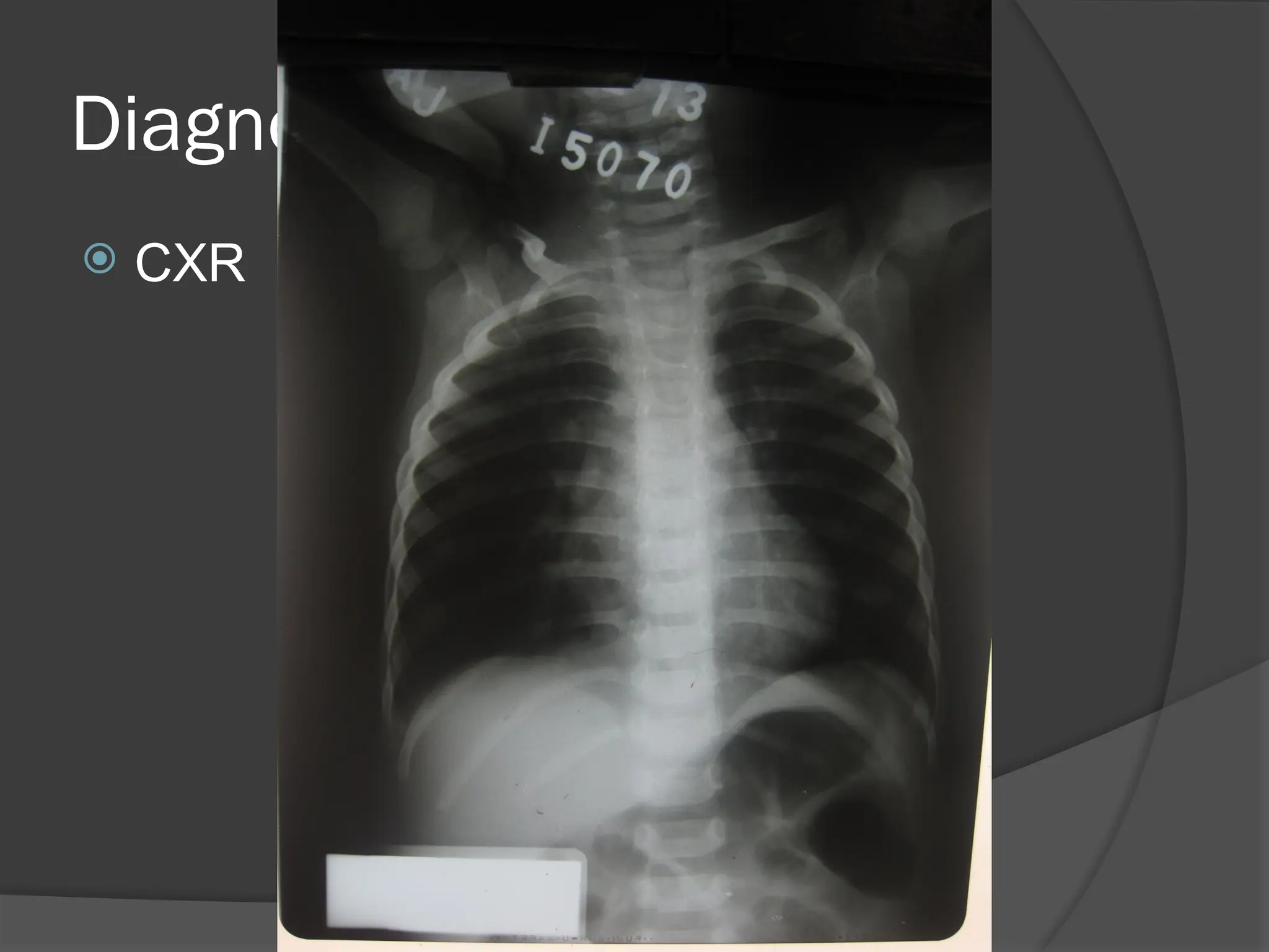 Simplified presentation Complex Febrile Seizure.pptx