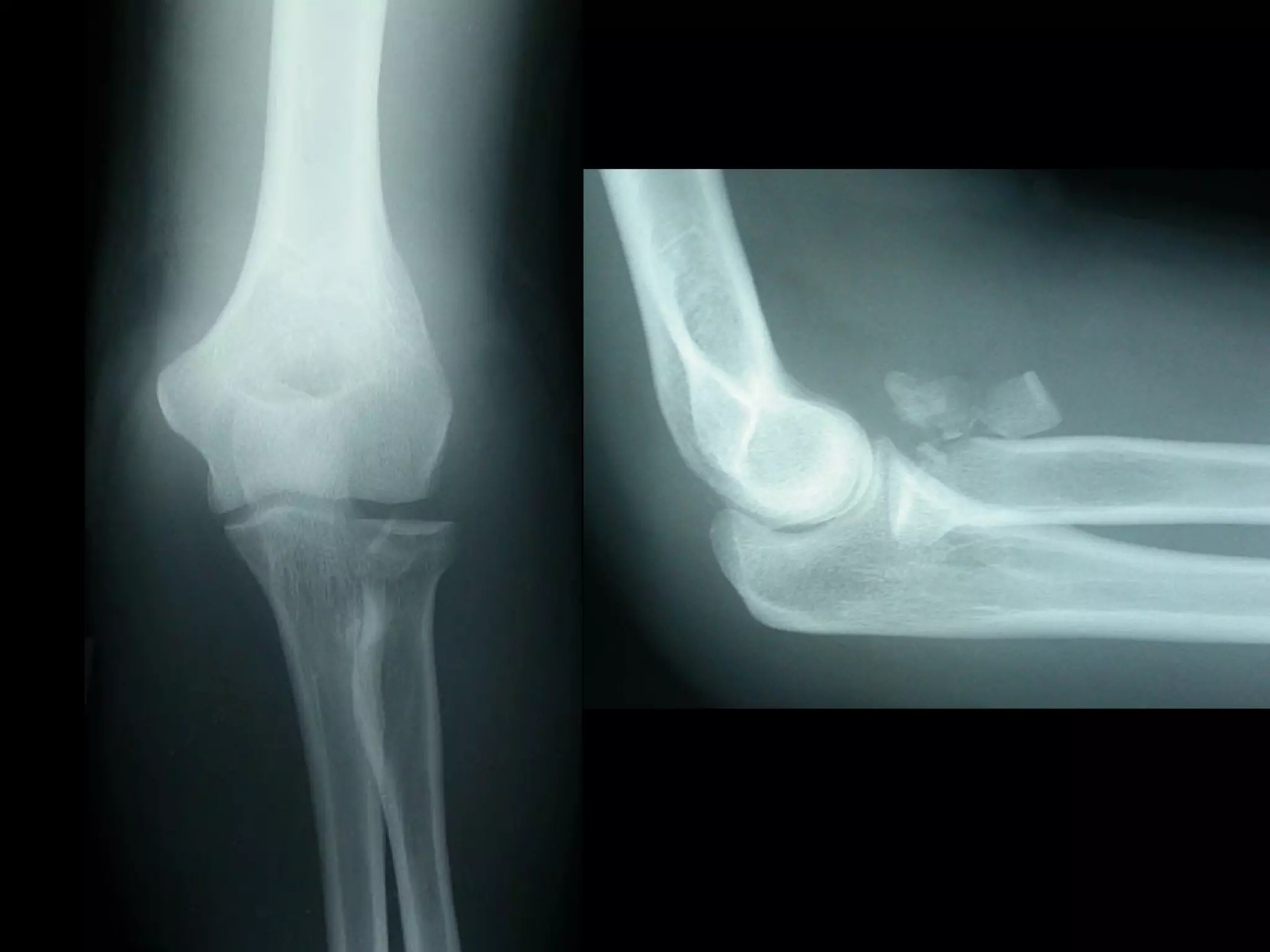 Complex fractures elbow eexot 2014 | PPT