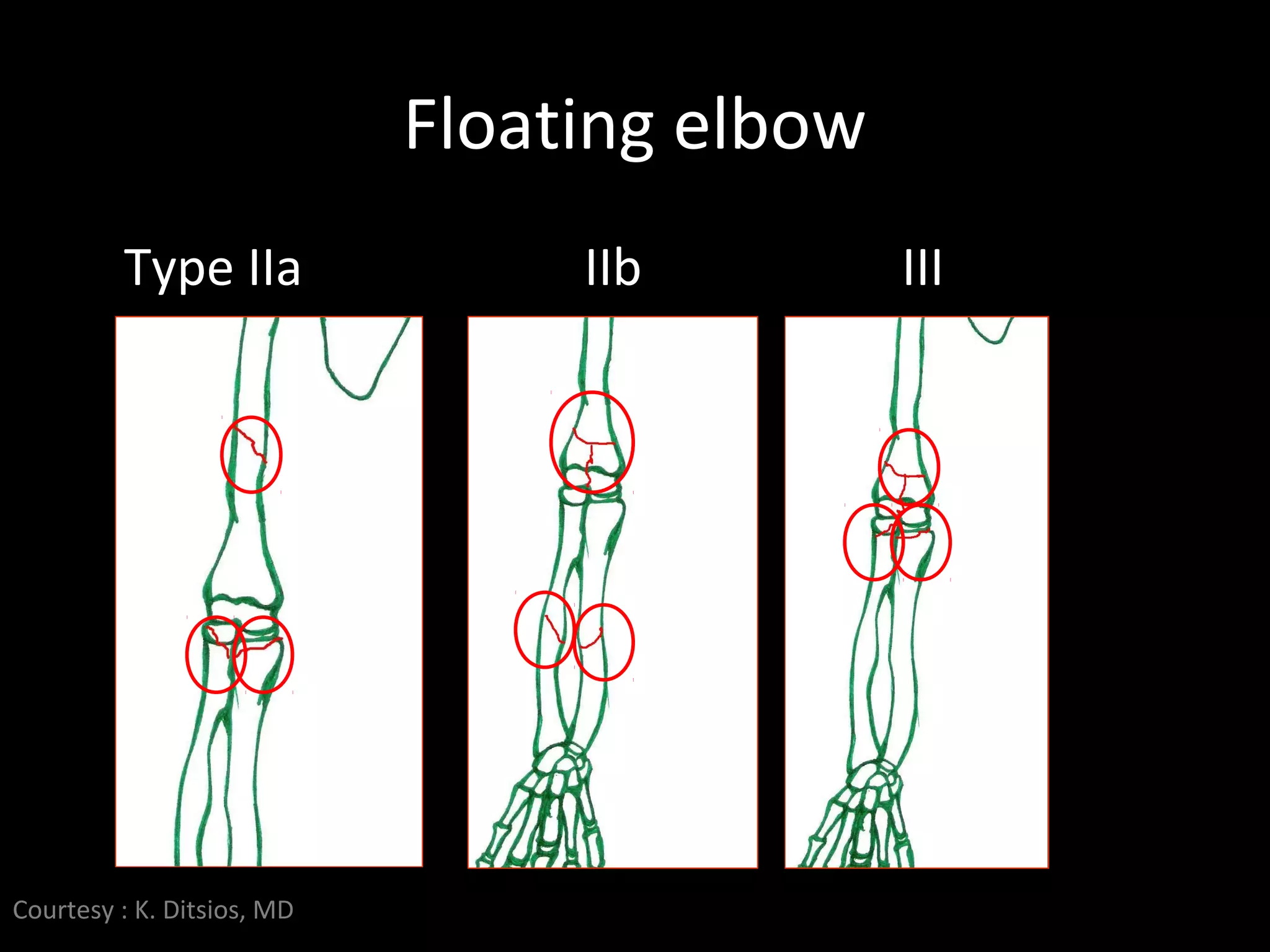 Complex fractures elbow eexot 2014 | PPT
