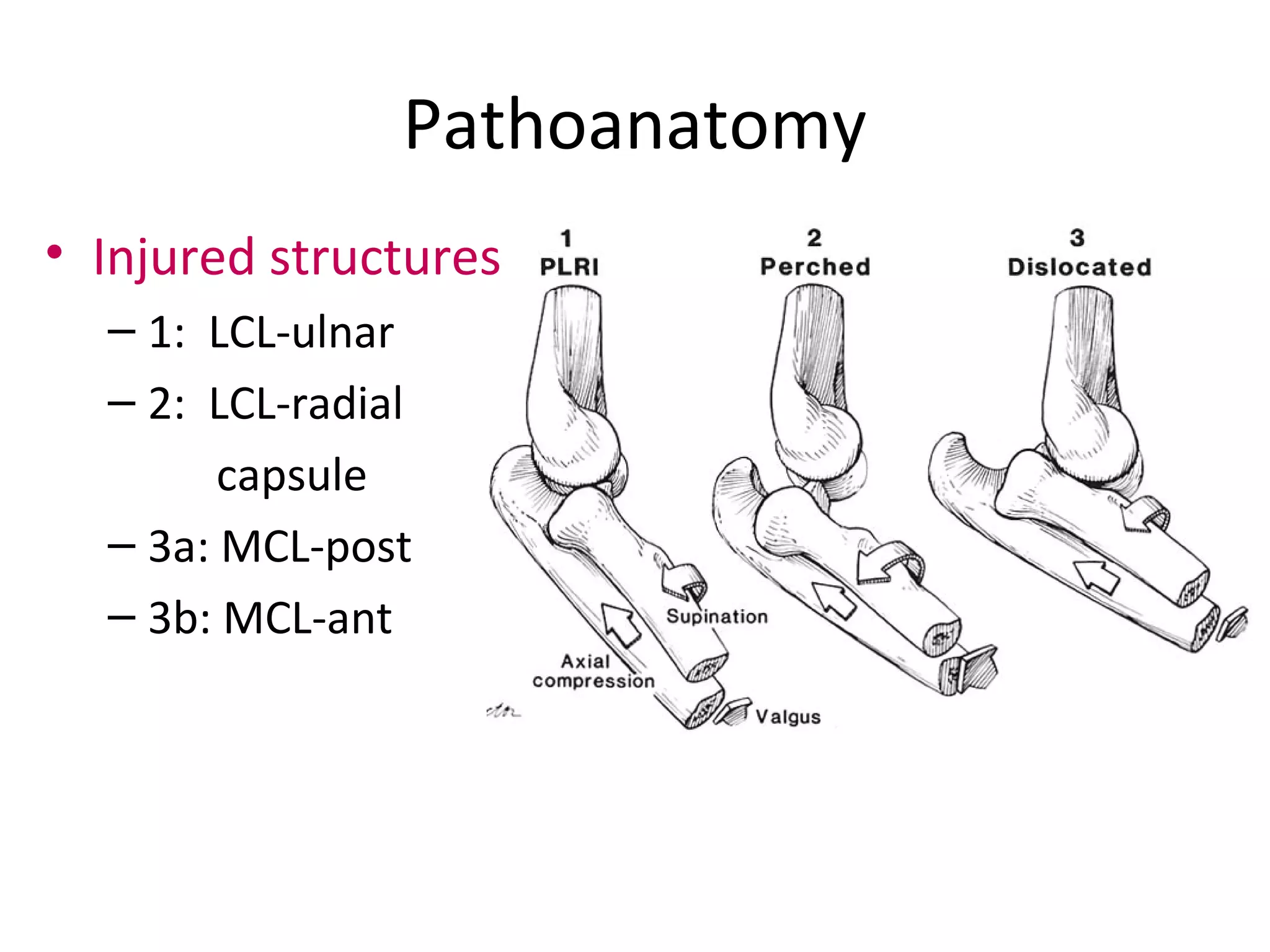 Complex fractures elbow eexot 2014 | PPT