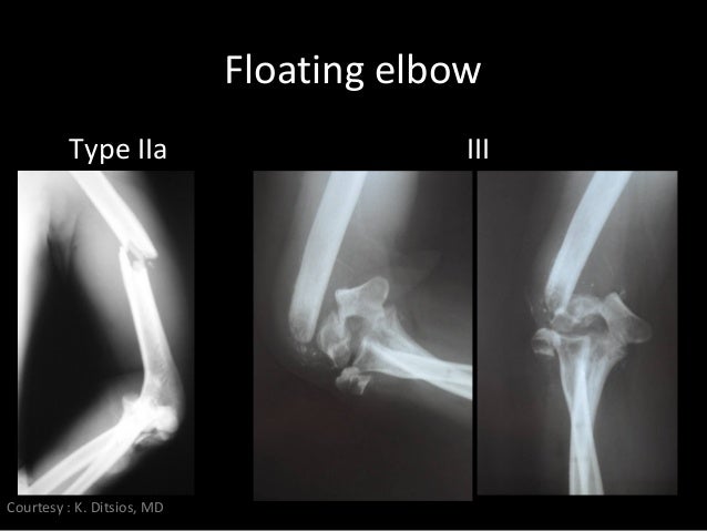 Complex fractures elbow eexot 2014