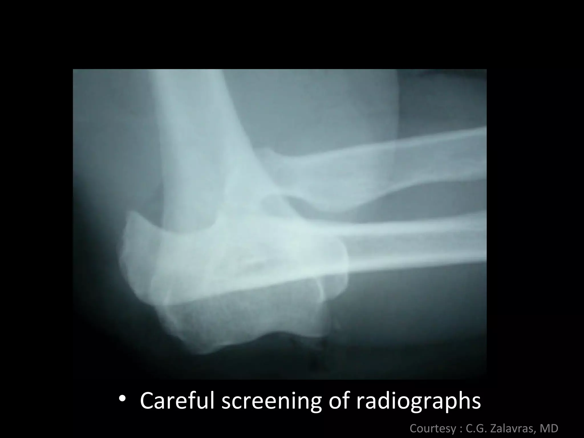 Σύνθετα Κατάγματα του Αγκώνα- Complex fractures of the elbow | PPT