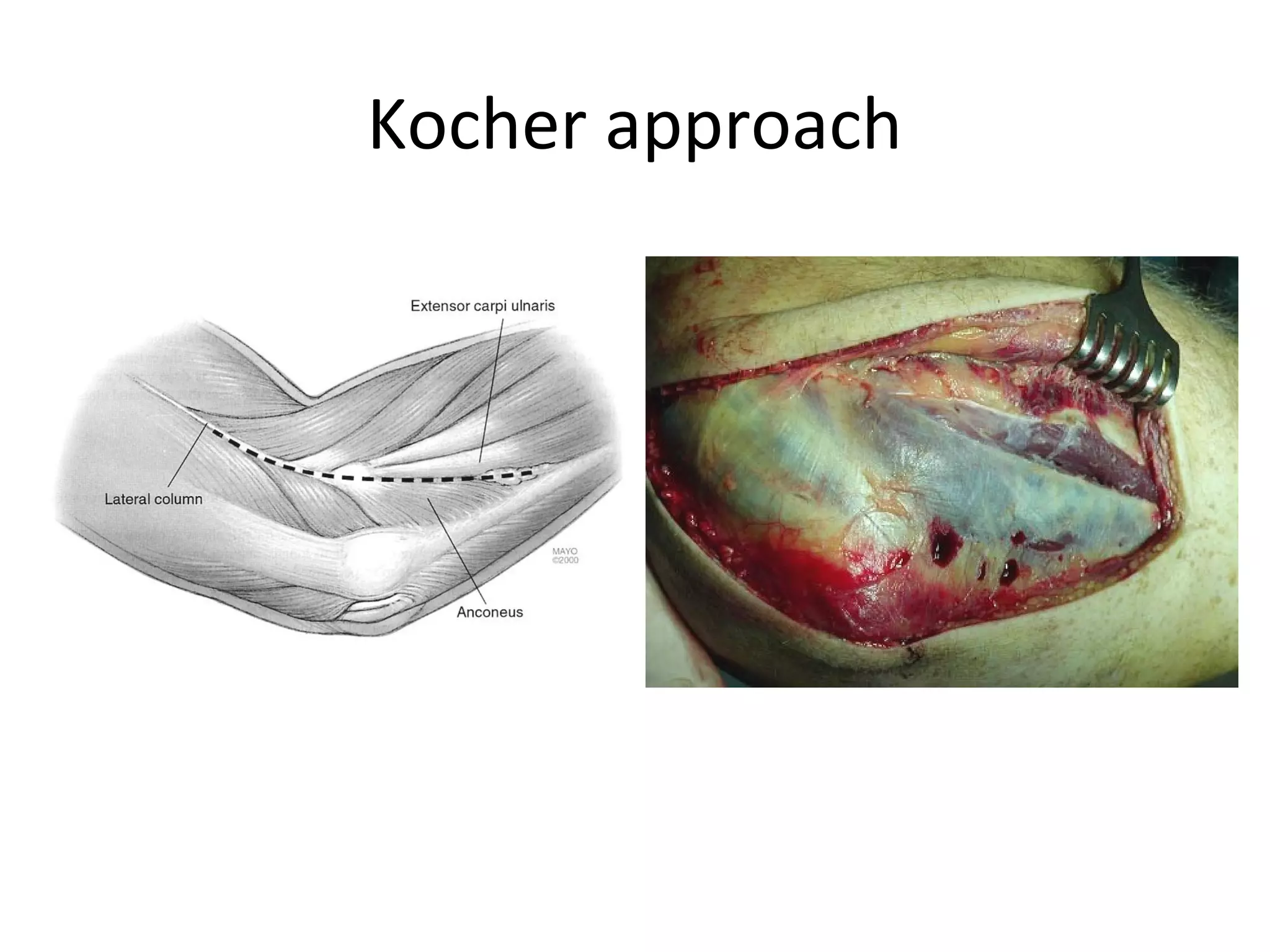 Σύνθετα Κατάγματα του Αγκώνα- Complex fractures of the elbow | PPT