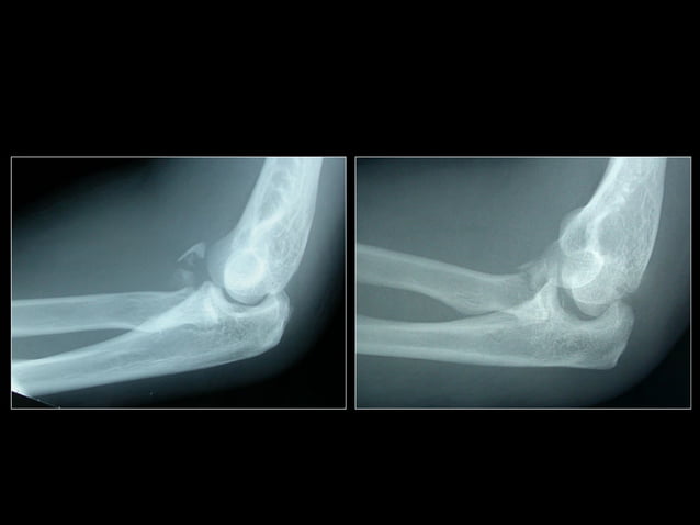 Σύνθετα Κατάγματα του Αγκώνα- Complex fractures of the elbow | PPT