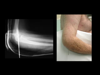 Σύνθετα Κατάγματα του Αγκώνα- Complex fractures of the elbow | PPT