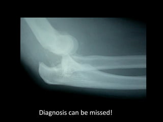 Σύνθετα Κατάγματα του Αγκώνα- Complex fractures of the elbow | PPT
