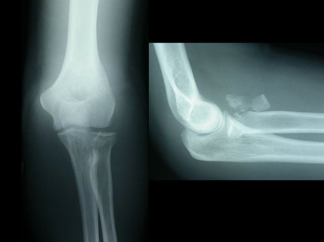Σύνθετα Κατάγματα του Αγκώνα- Complex fractures of the elbow | PPT