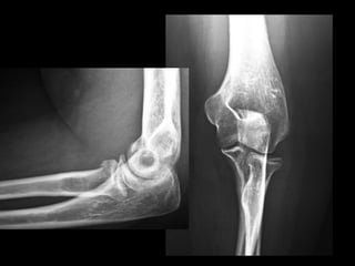 Σύνθετα Κατάγματα του Αγκώνα- Complex fractures of the elbow | PPT